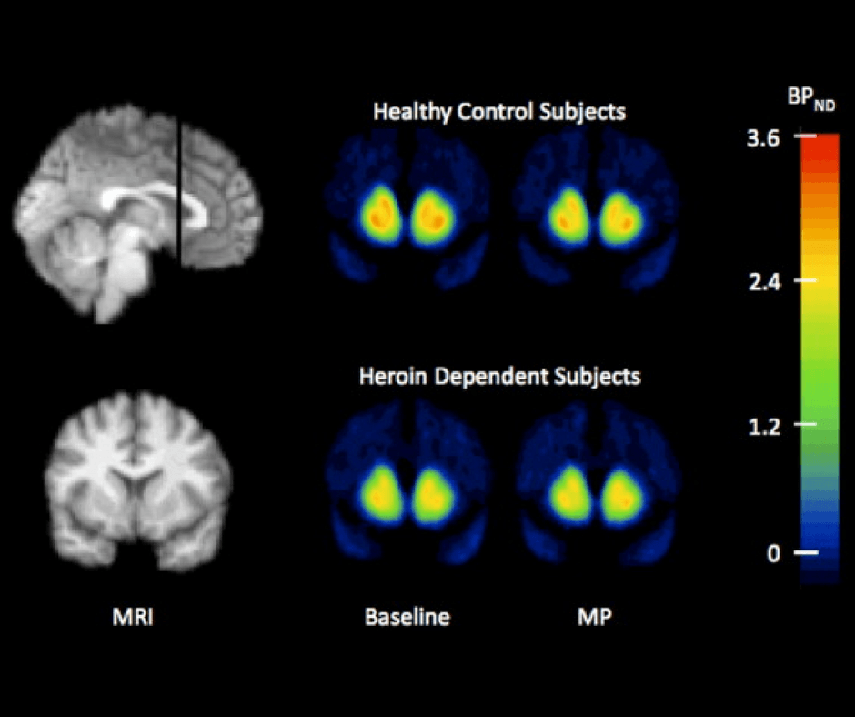 Opiate Addiction Brain